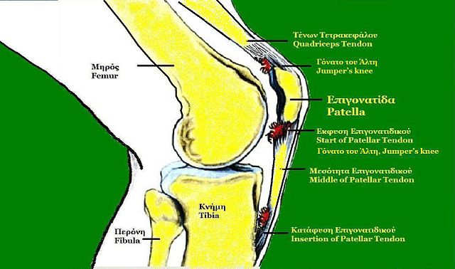 Patellar Tendinitis